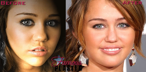 Miley Cyrus Plastic Surgery Before and After Photos | Famewatcher